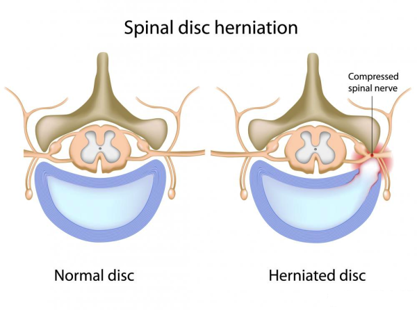 Spinal Disc Herniation Homeopathic Treatment in Pakistan