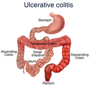 What is Ulcerative Colitis and How to Treat it Using Homeopathy Medicines