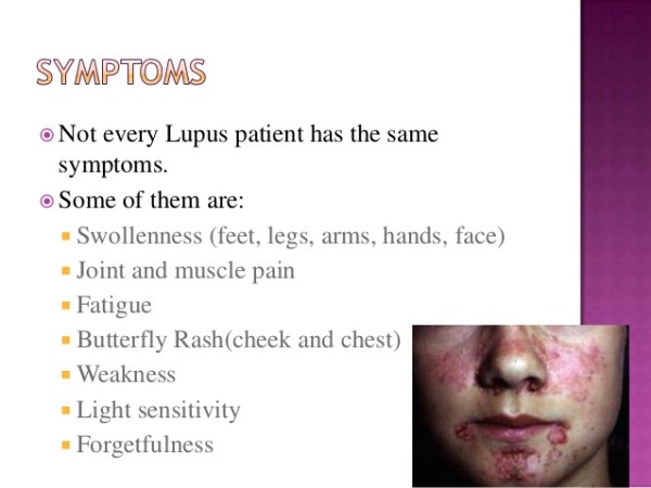 Butterfly Rash and Its Best Cure By Homeopathic Medicine