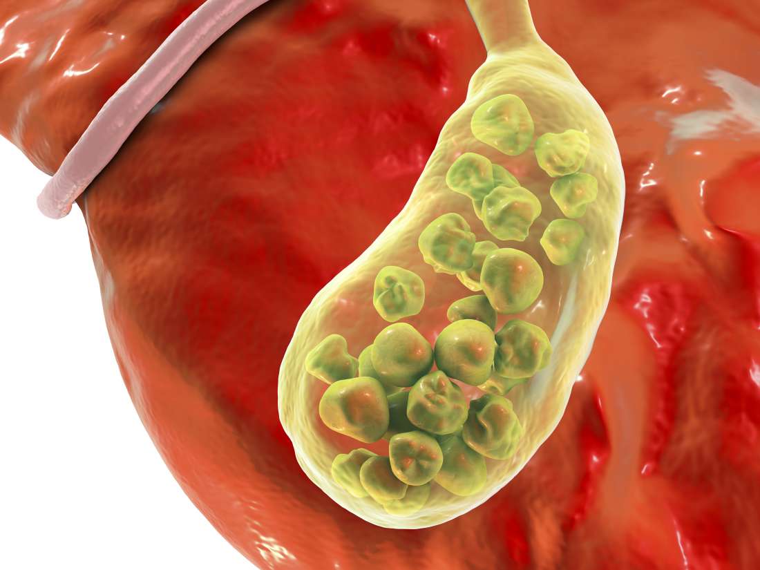 Gallbladder Stone And Fibroids Cured By Homeopathic Medicine