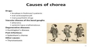 Chorea Basic Causes Types Diagnosis and Homeopathic Treatment