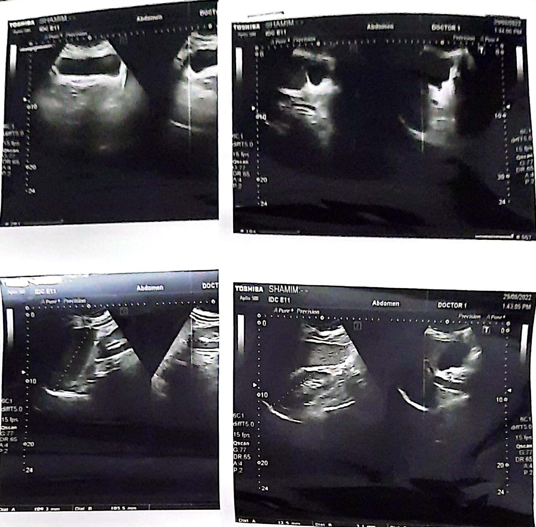 Ascites enlarged spleen and liver cured by Homeopathic Treatment